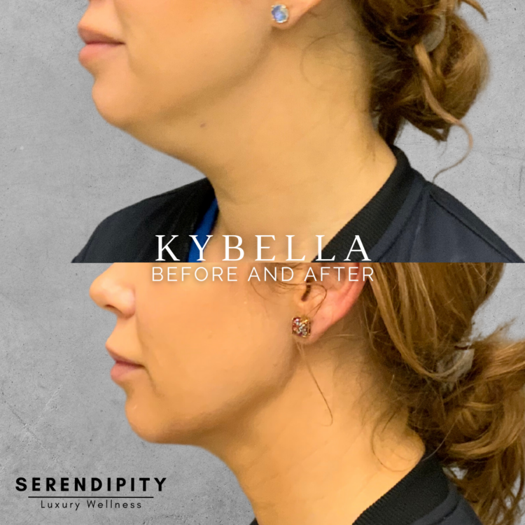Kybella Houston | Before and After | Serendipity | Luxury Wellness
